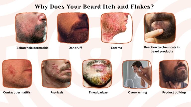 Why Your Beard Itches and Flakes: Seborrheic Dermatitis or Product ...